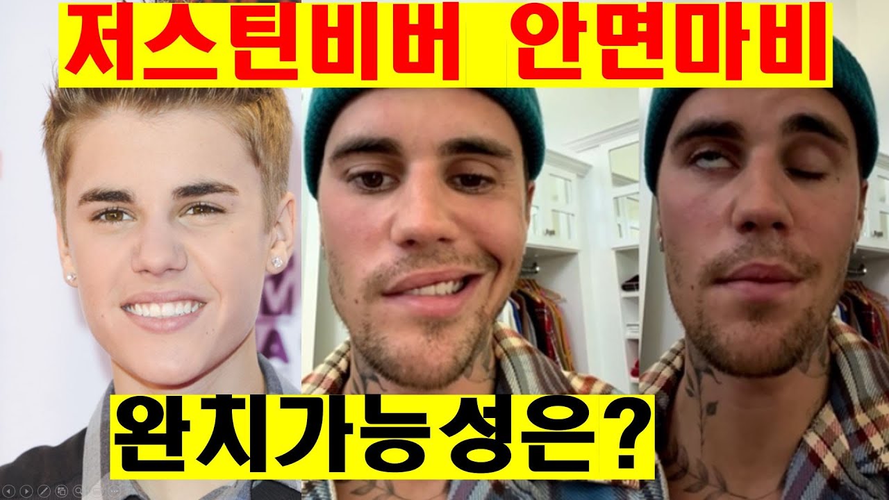 저스틴비버 안면마비 람세이헌트 증후군 완치 가능성은 Youtube