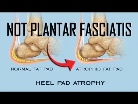 NOT PLANTAR FASCIATIS | Heal Fat Pad Syndrome (Body Mechanics 101 ...