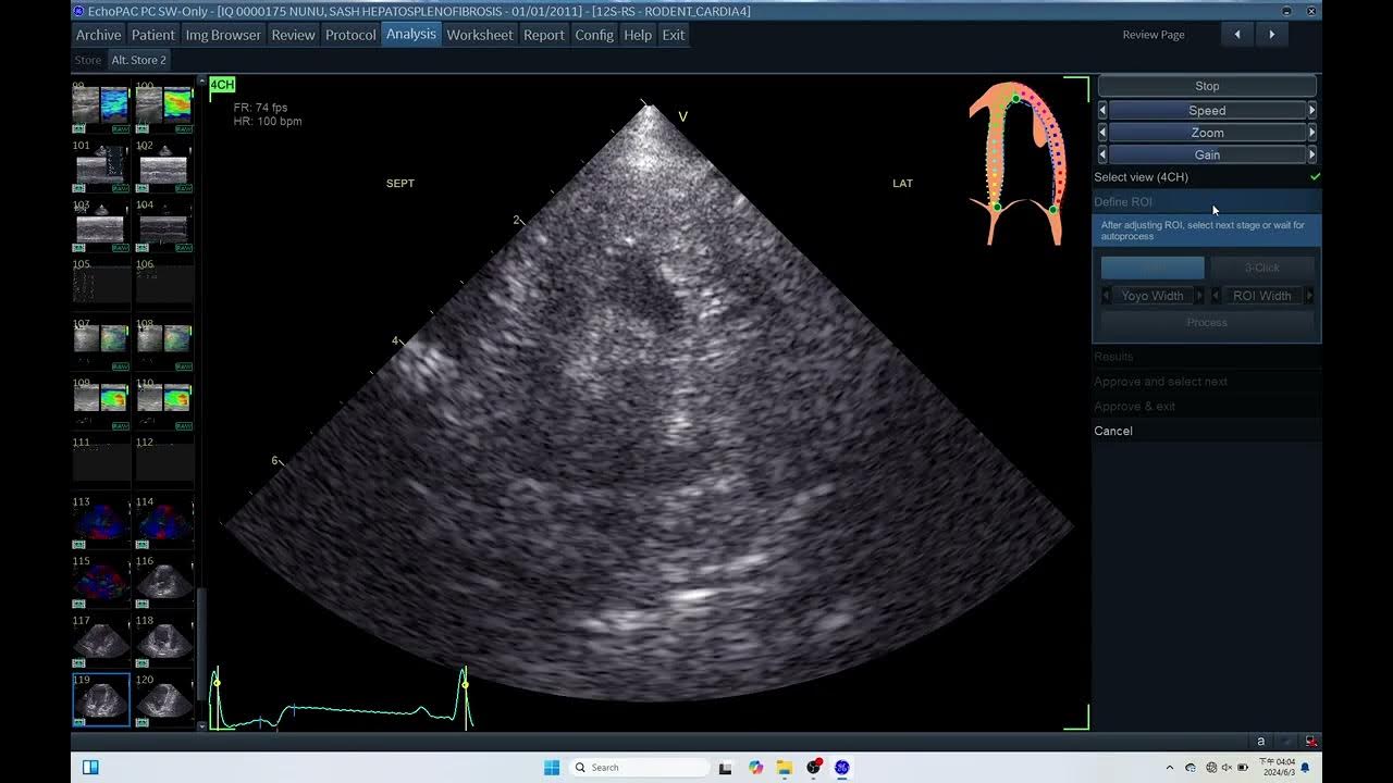 IQ 175 AFI LV ECHOCARDIOGRAPHY ECHOPAC ANALYSIS - YouTube