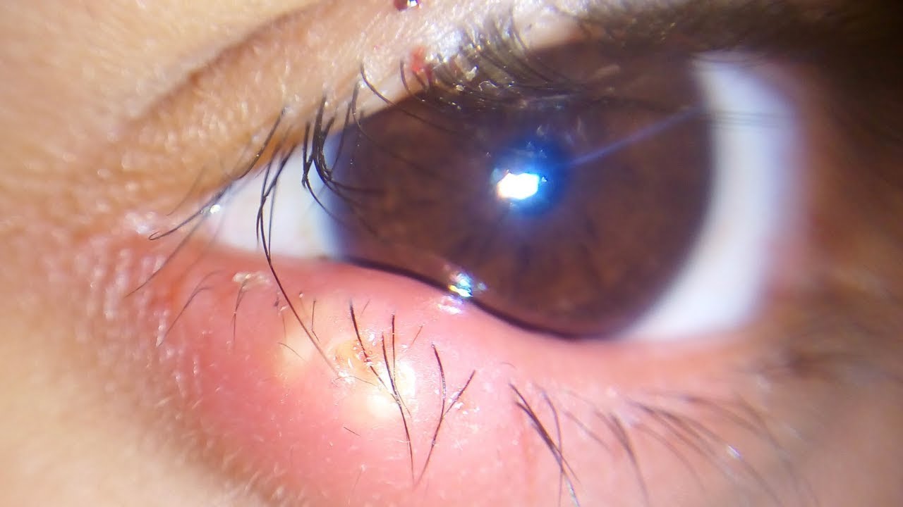 how to get rid of a stye in 2 hours - YouTube