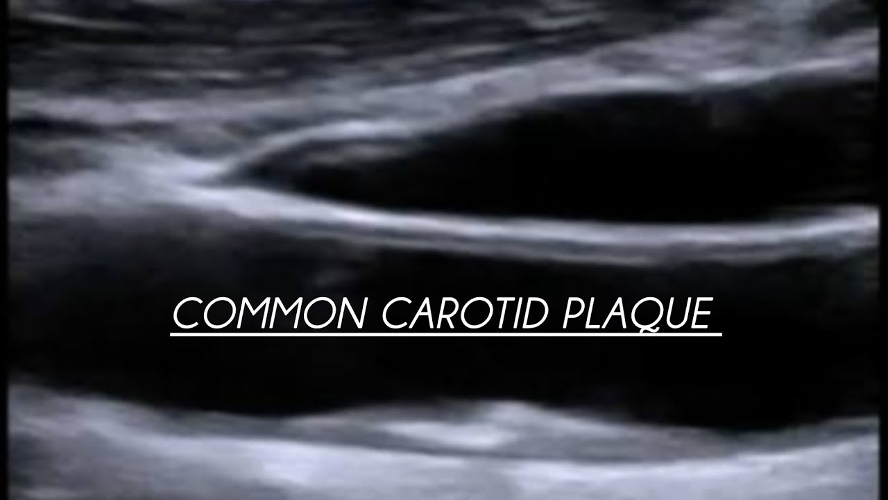 Ultrasound of Carotid Artery Plaque: Detection & Interpretation - YouTube