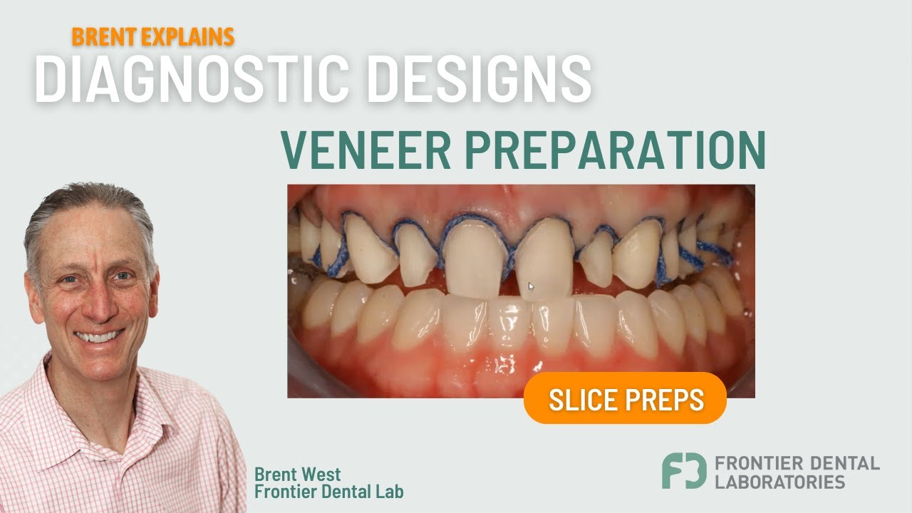 Veneer Preparation: Slice Preps Explained - YouTube