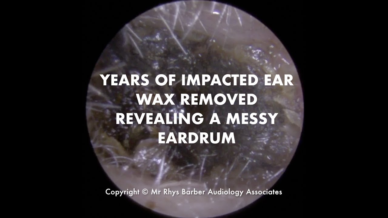 Years of Impacted Ear Wax Removed Messy Eardrum Revealed - Ep 12 - YouTube