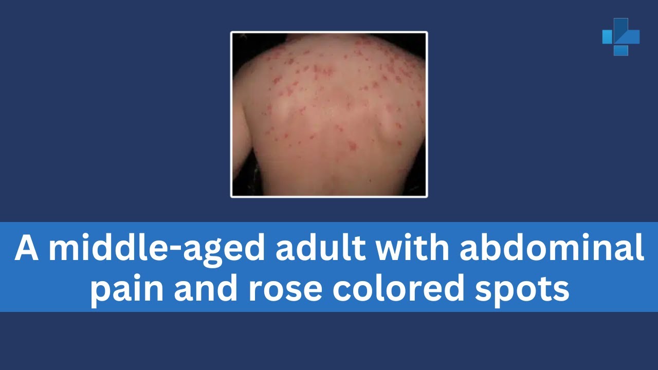 A middle aged adult with abdominal pain and rose colored spots - YouTube