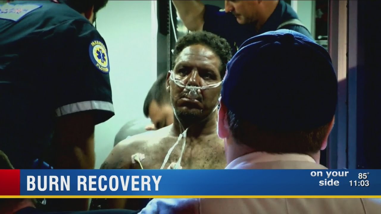 Many burn victims face long recovery, physical and emotional - YouTube