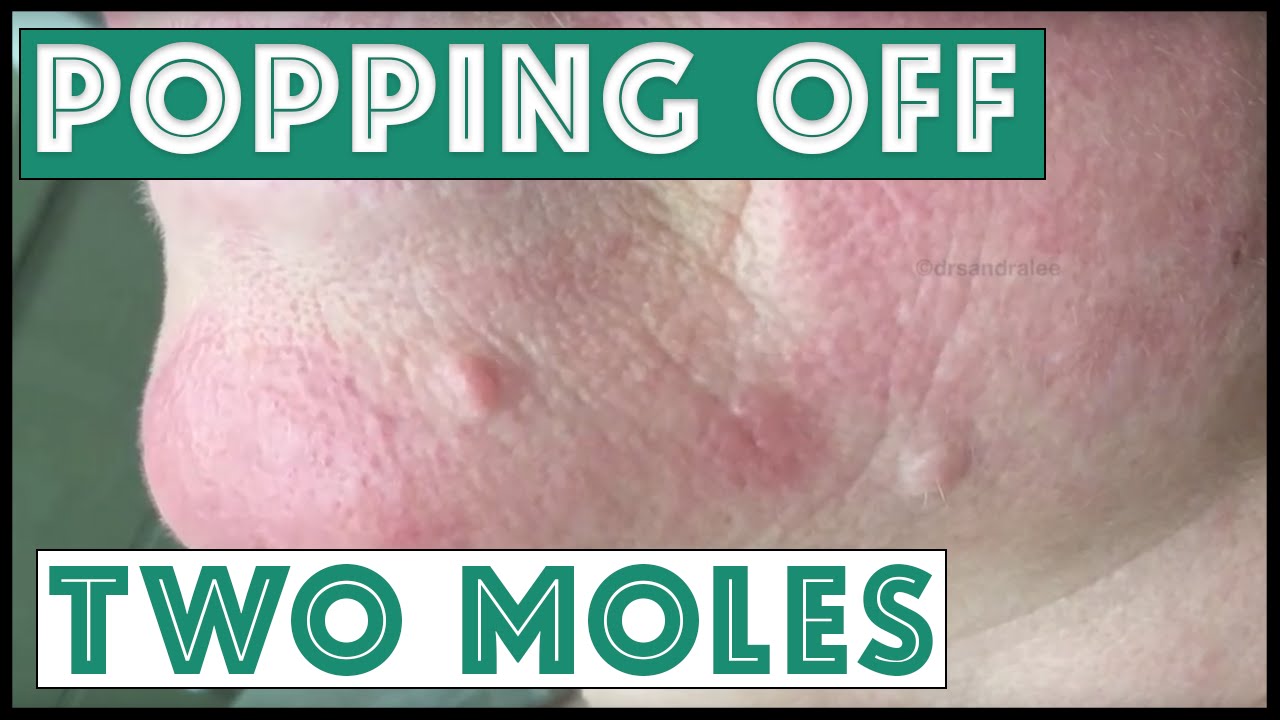"Popping" off two moles on the face. For medical education- NSFE - YouTube
