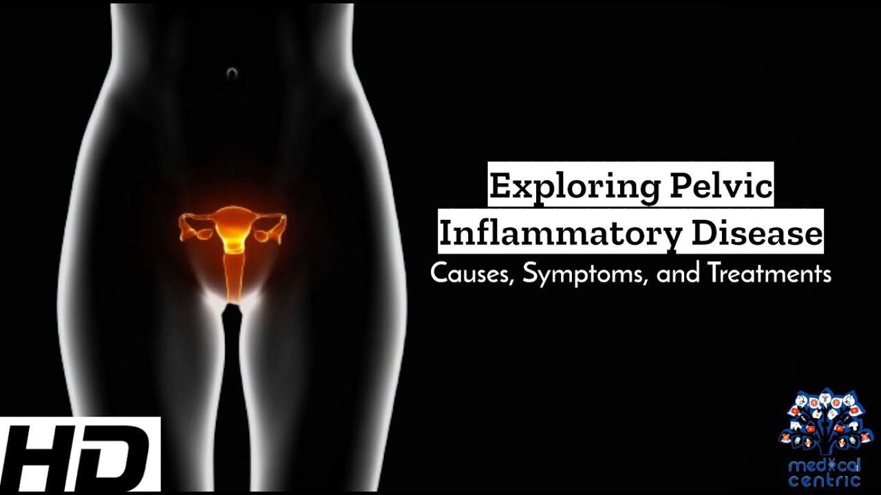 Pelvic Health Matters: Navigating the Landscape of Pelvic Inflammatory ...