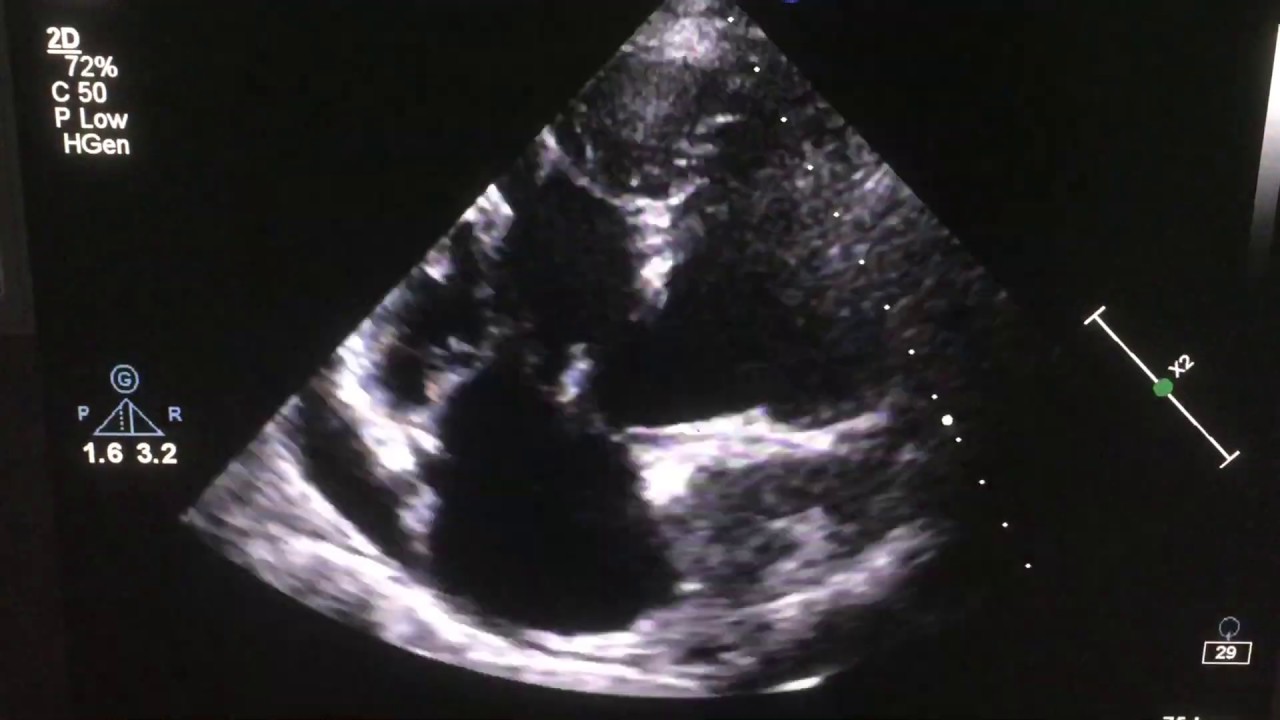 What Is The Difference Between Pda And Pfo At Jennifer Marshall Blog