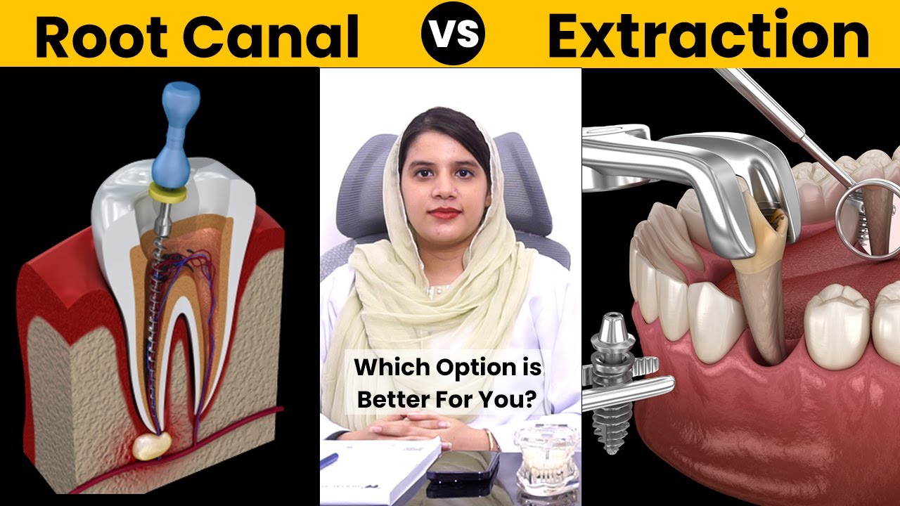 Root Canal Treatment (RCT) vs Tooth Extraction: Which Option is Better ...