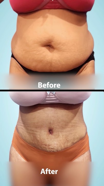 Abdominoplasty - Tummy Tuck Transformation | Tummy Tuck Surgery Result #shortsfeed - YouTube