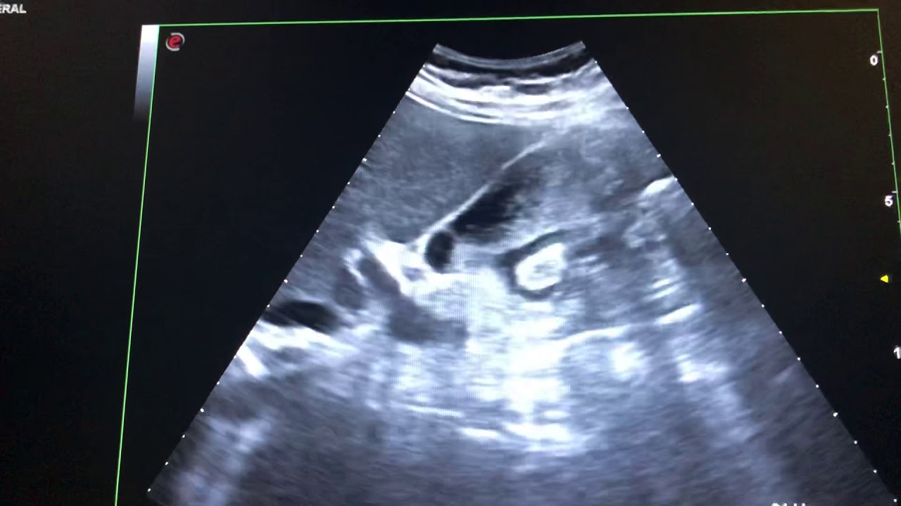 Barro biliar Ecografia vesícula biliar - YouTube