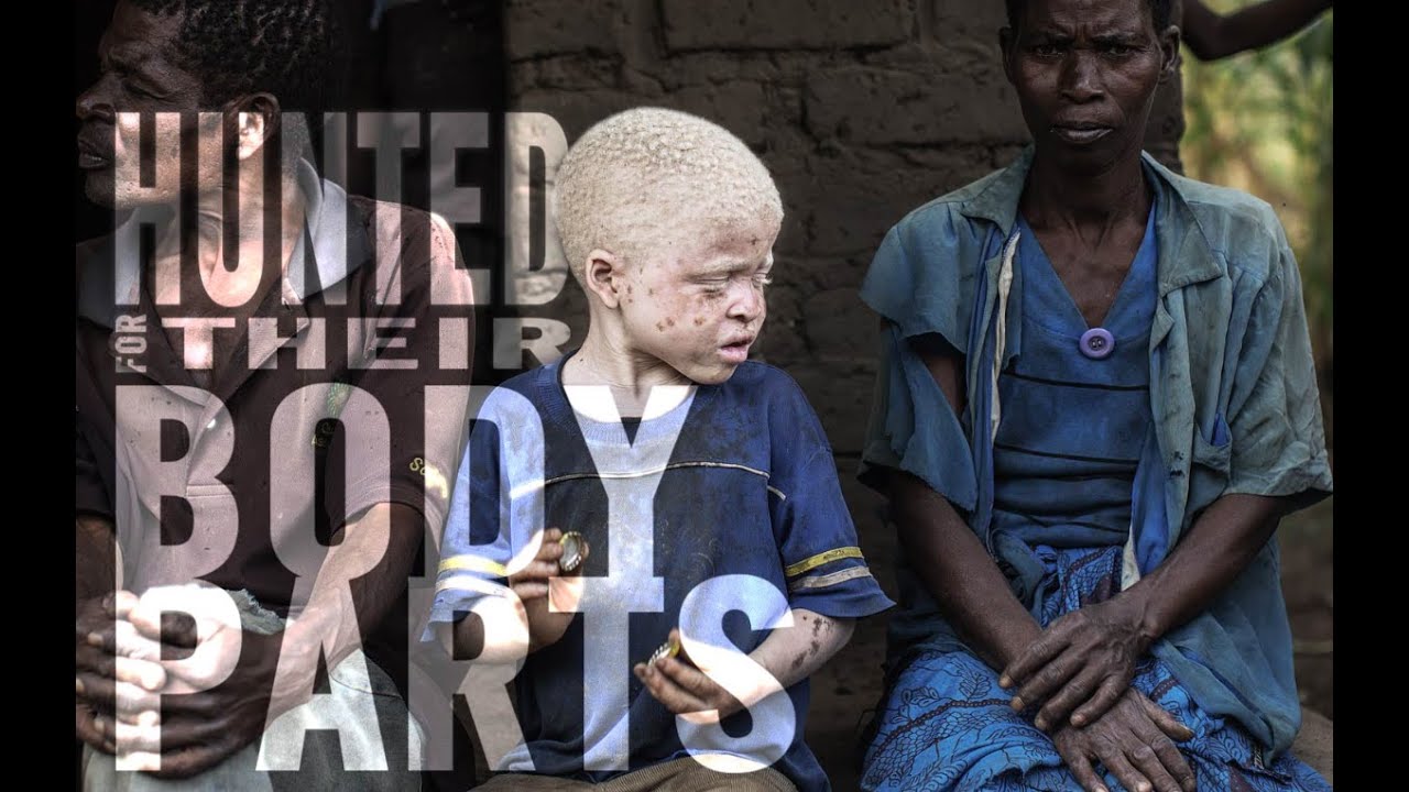 Albino People Hunted
