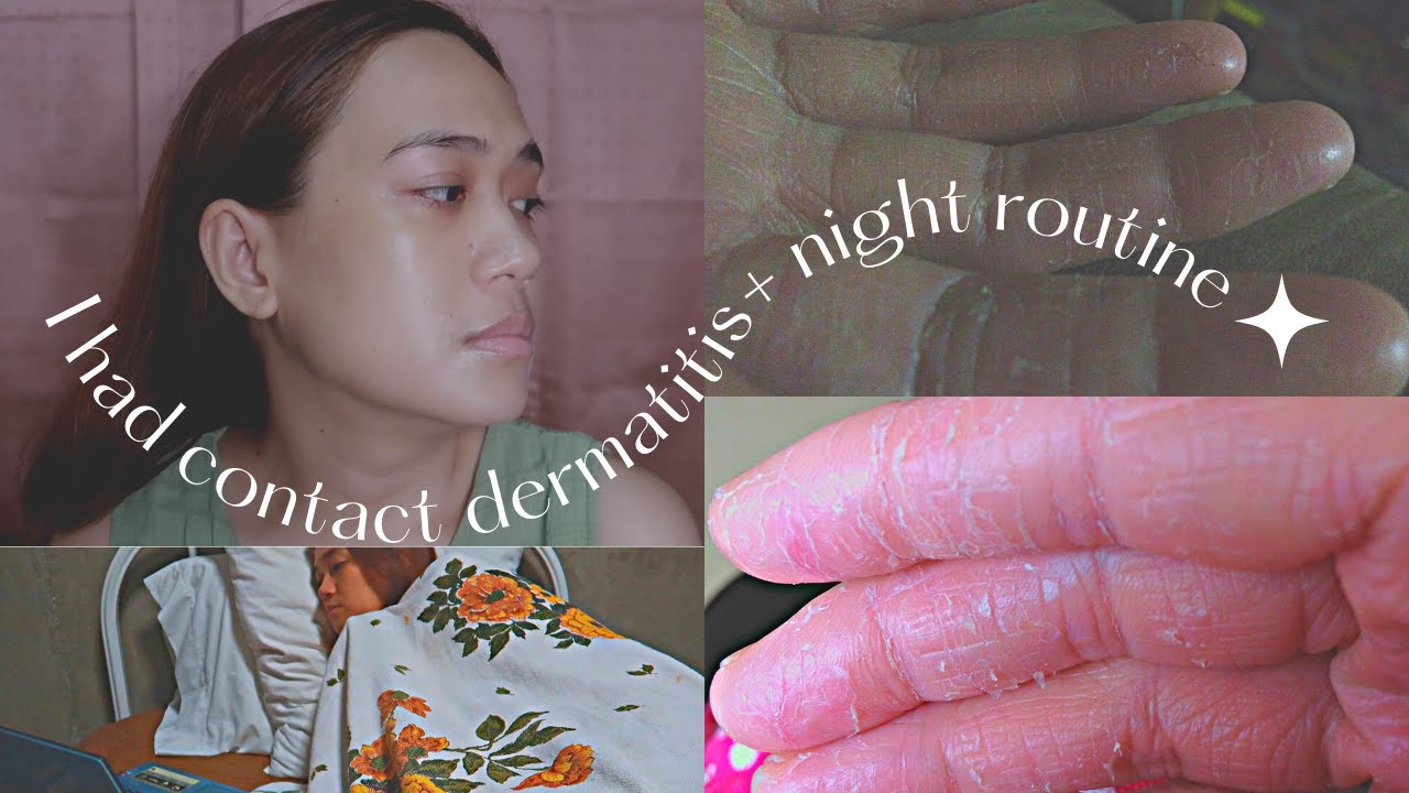 How to cure contact dermatitis? *treatment + what I used?* | GRWM night ...