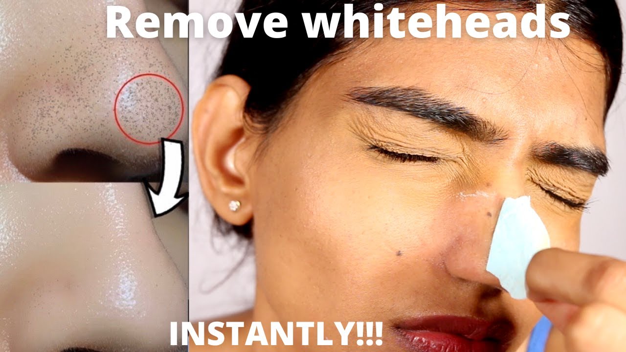 How To Remove Clogged Pores At Home | Get Rid Of Blackheads, Whiteheads & Acne - YouTube