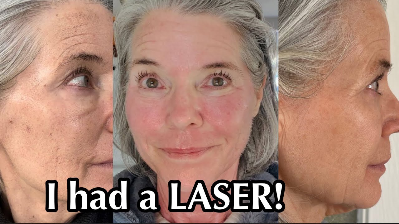 My Top 3 Tips to Fade Dark Spots, Sun Spots, Age Spots ...