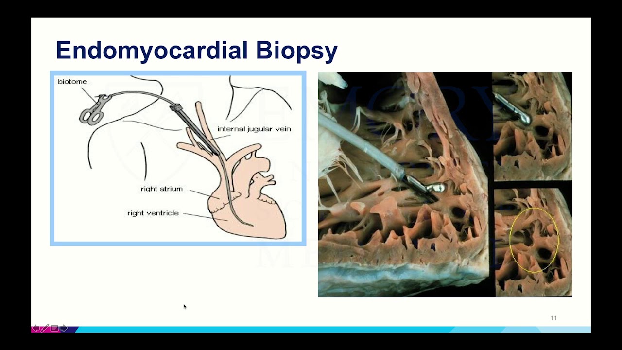Emory Cardiology Grand Rounds 1-28-2019 - YouTube