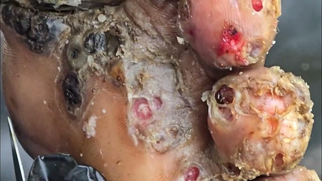 Amos Obukanga's BIG JIGGERS REMOVAL on left foot Oct 4th 2024 - YouTube