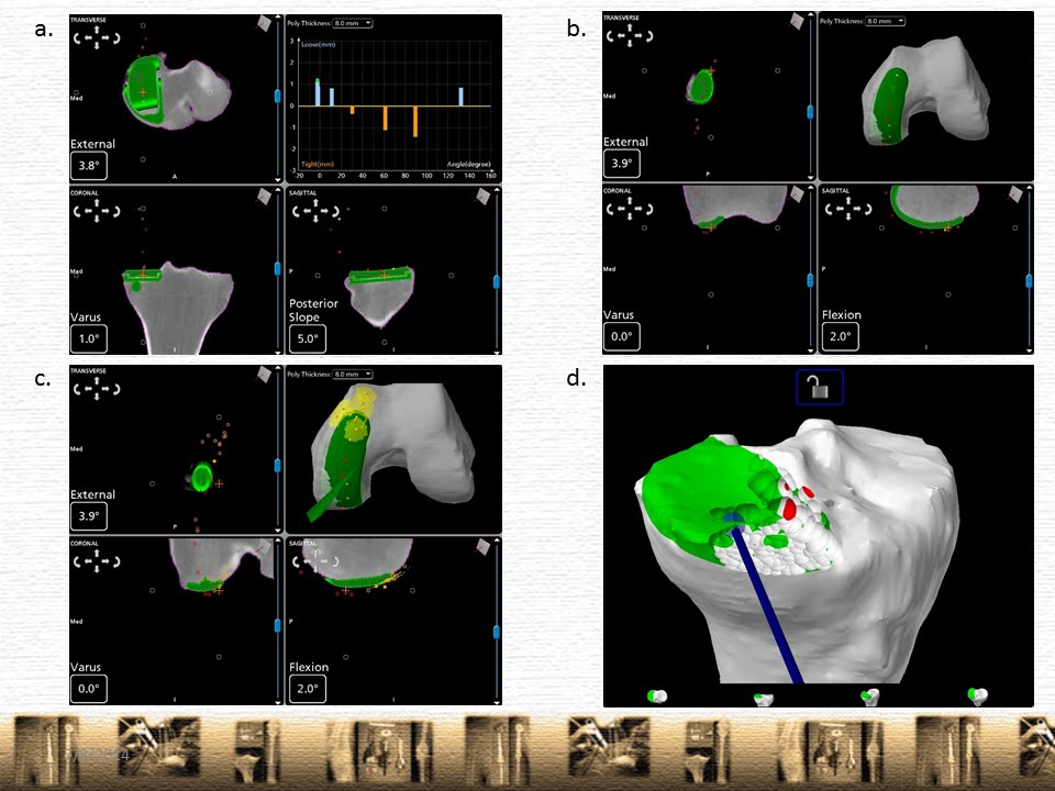 Makoplasty Robot Assisted Partial Knee Replacements in Singapore - YouTube