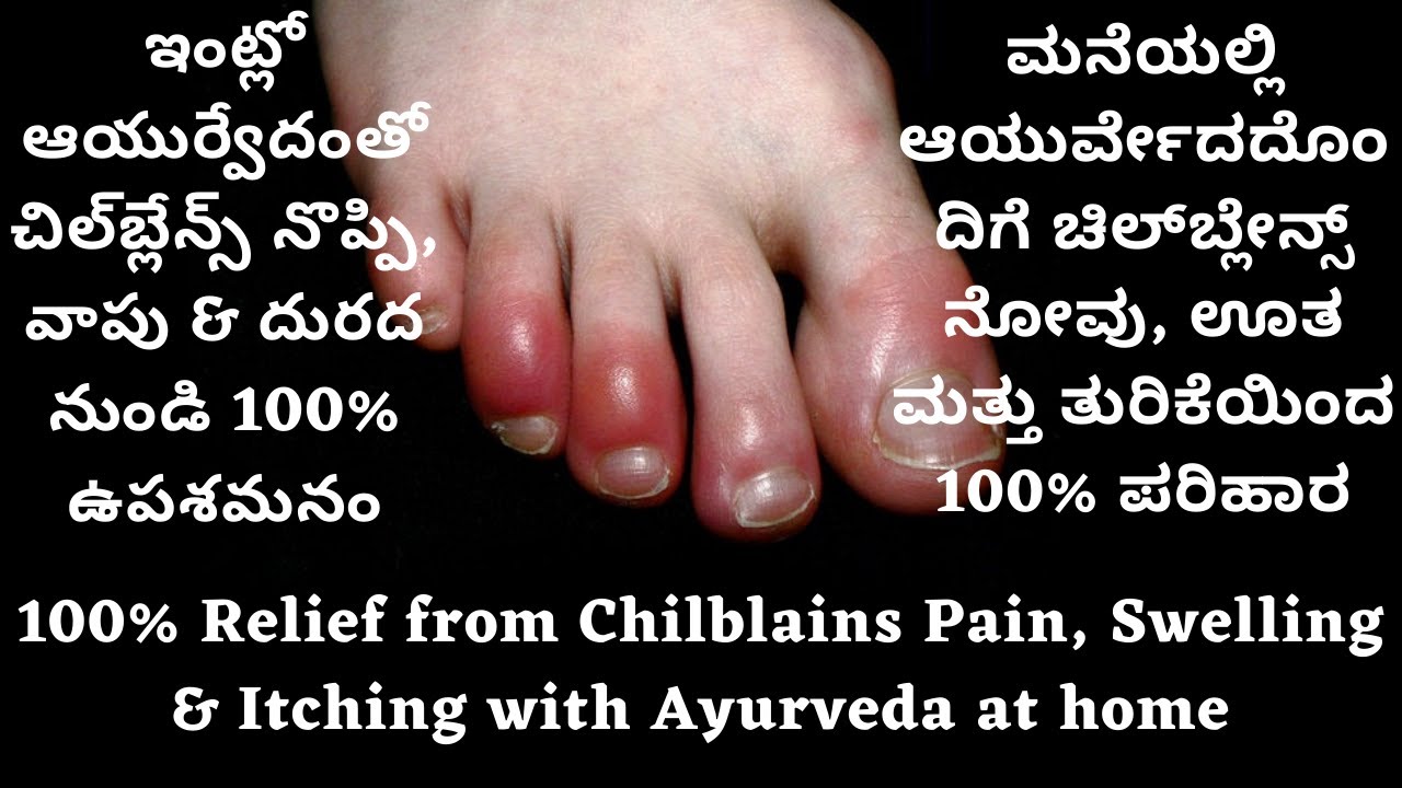Chilblains Ayurveda Remedy in English/How to get relief from Painful ...
