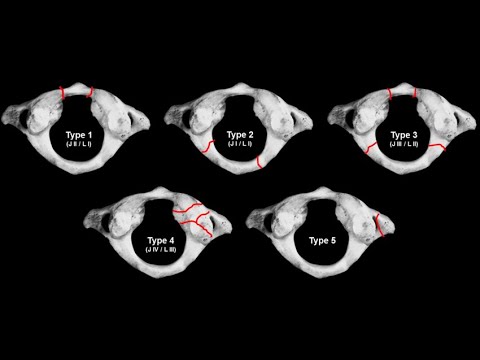 Jefferson fracture (C1 ring fracture) and hangman’s fracture (C2 ...