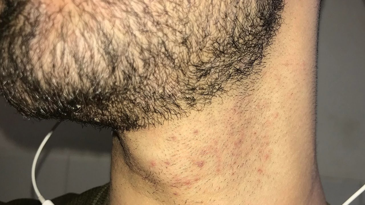 how to get rid of ingrown hairs on neck DO THIS - YouTube