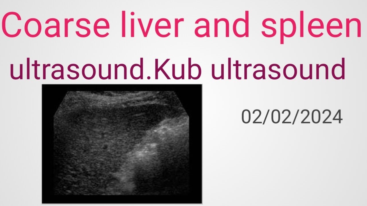 Coarse liver ultrasound!Coarse echo texture liver ultrasound!Spleen ...