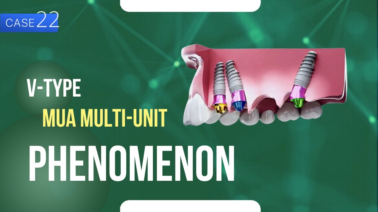 V Type XGATE Dental MUA multi unit Phenomenon - YouTube