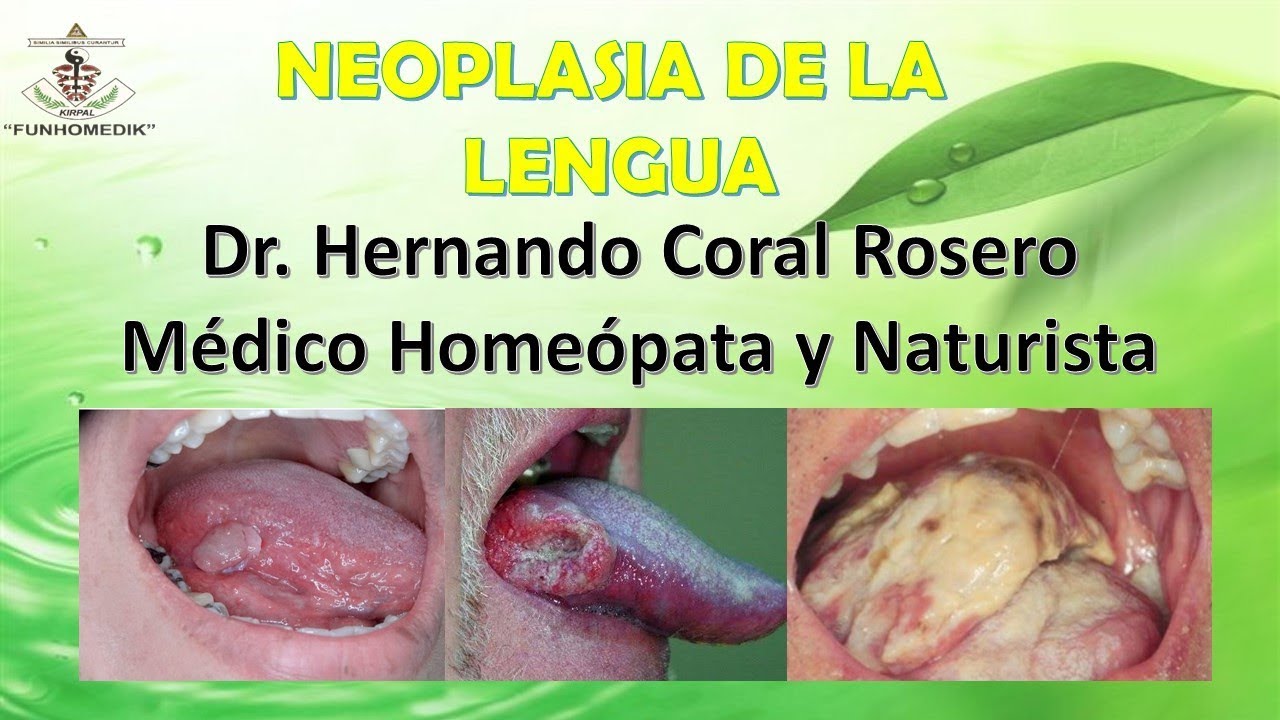 NEOPLASIA DE LA LENGUA- CÁNCER BUCAL (ORAL) - YouTube