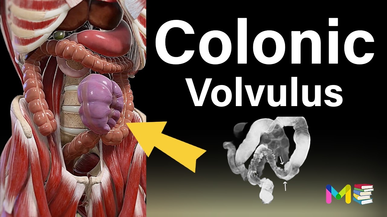 COLONIC VOLVULUS (Types, Causes, and Symptoms) - YouTube