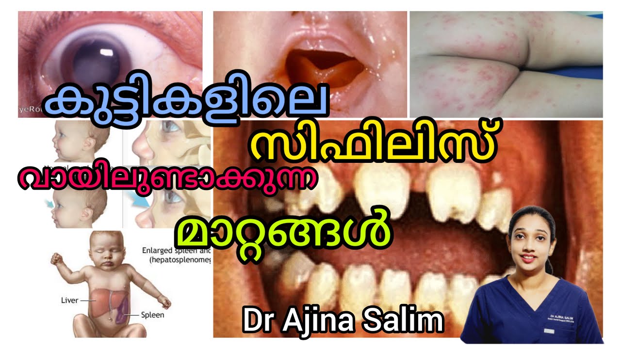 Oral changes in Congenital Syphilis | Syphilis in new born| Oral ...