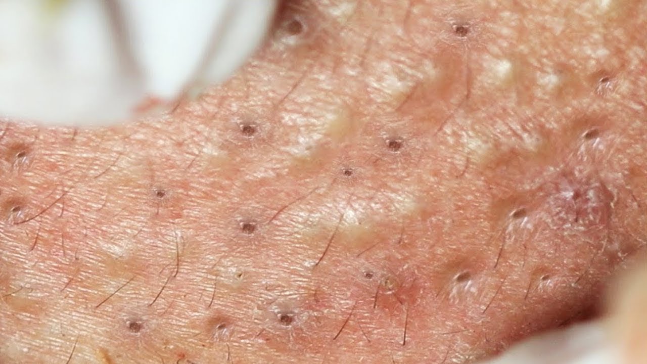 Deep blackhead extraction Cystic acne & pimple popping #55 - YouTube
