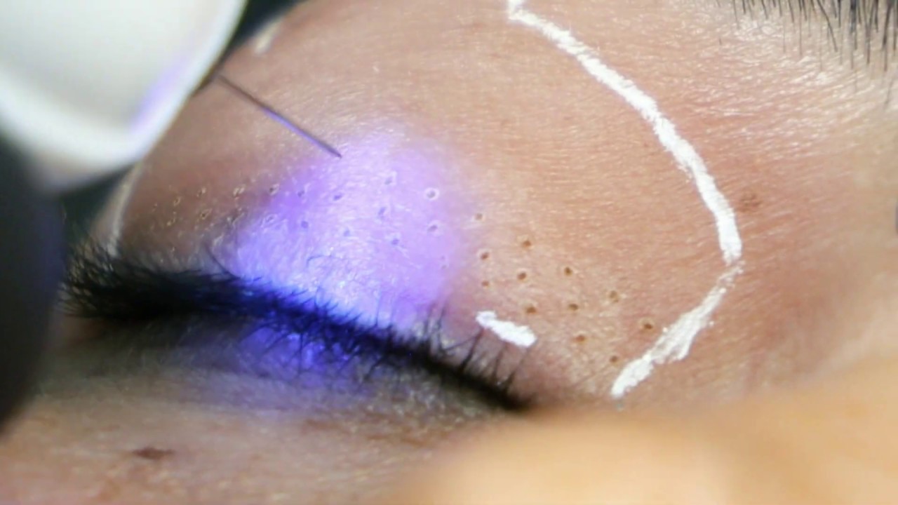 Fibroblast Parpados Caidos - YouTube