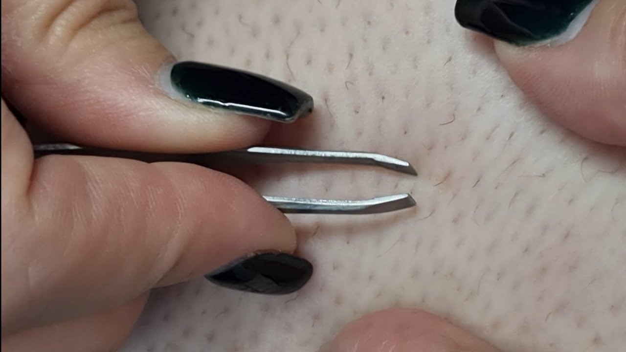 Satisfying Hair Removal & Ingrown Hair Removal using Tweezers - YouTube