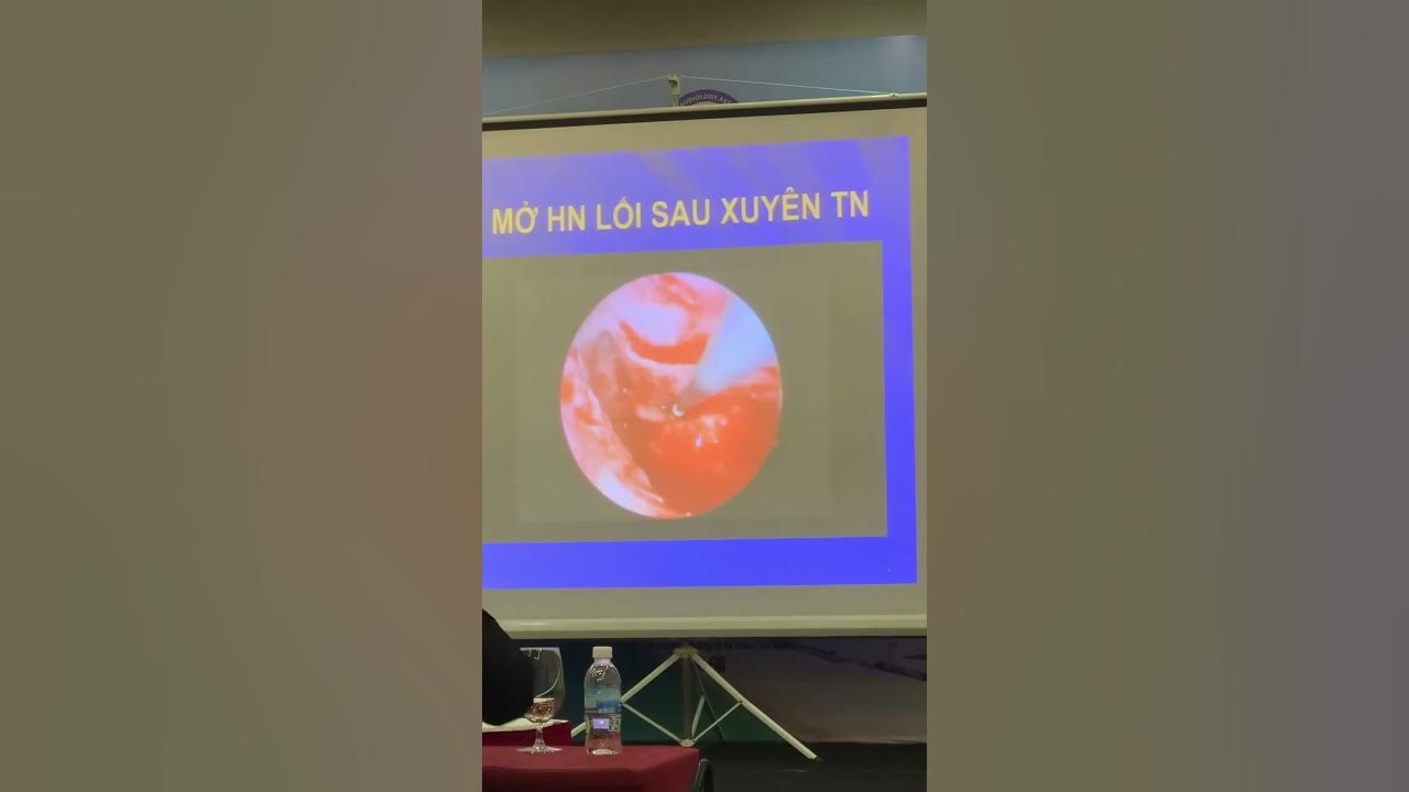 Mở hòm nhĩ lối sau xuyên thượng nhĩ - PGS Nguyễn Tấn Phong - YouTube