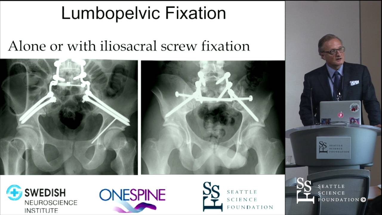 Sacral & Pelvic Fixation Options for Spine Tumors by Jens Chapman, MD ...