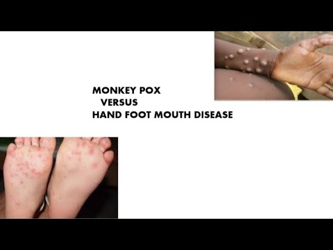 How to differentiate between Monkey Pox and Hand Foot Mouth disease ...
