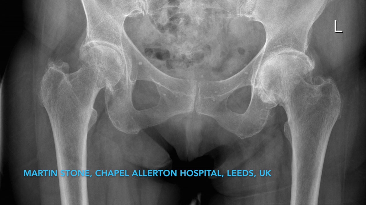 Protrusio of the hip and ease of dislocation. - YouTube