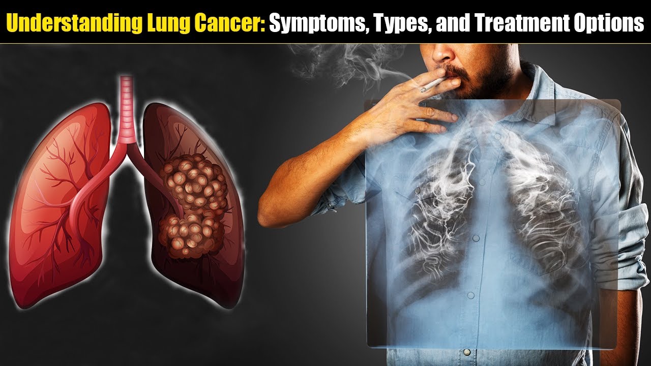 Lung Cancer Survival Causes Diagnosis Treatment And Management Youtube