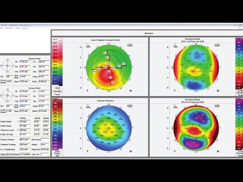 How To Read Corneal Topography Maps | Pentacam Quad Maps - YouTube