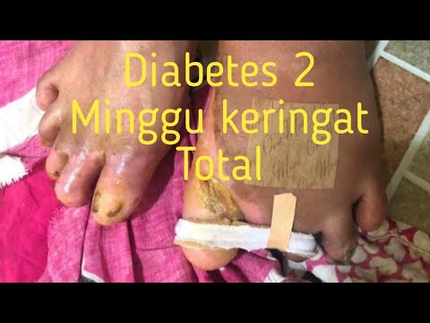 DIABETES Basah 2 Minggu kering Total dengan Koyok Ajaib PNG - YouTube