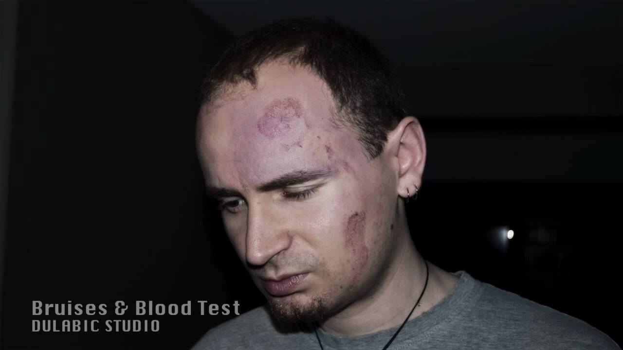 Bruises & Blood - Test - YouTube