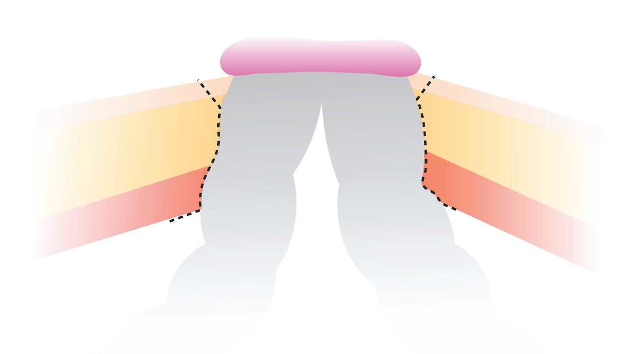 How Closure of Transverse Loop Colostomy is Performed in Russia - YouTube