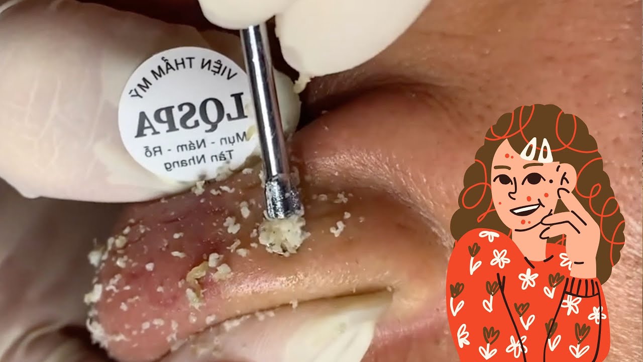Extreme Relaxing | Cleaning Facial | Acne ASMR #34 - YouTube