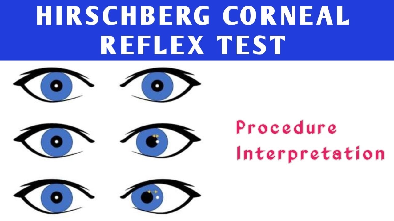 Squint Evaluation with Hirschberg corneal reflex test @eyecareoptom5506 ...