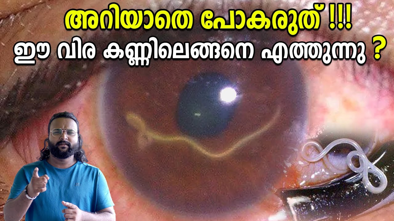 നമ്മുടെ കണ്ണിന് പണി തരുന്ന പാരസൈറ്റുകൾ |Eye Parasites |eye worms - YouTube
