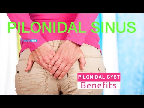 PILONIDAL SINUS, What is it? Who gets it? How to prevent and treatments ...