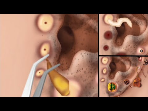 Biggest ear waxing | and rust earring ear treatment Clean ear Asmr # ...