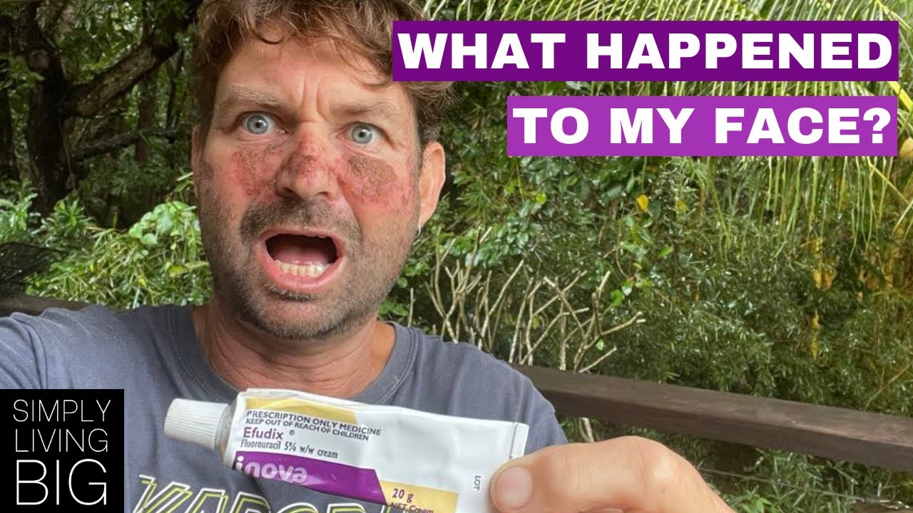 Using efudix cream on your face, my tips and experience. - YouTube