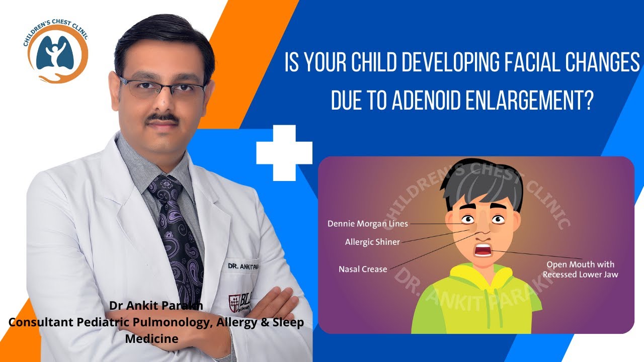 Adenoid Facies Features