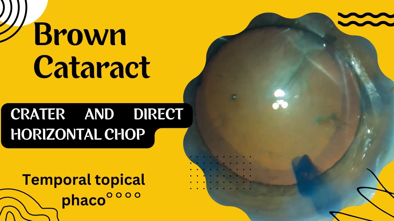 Case series 43. Brown cataract, crater and direct horizontal chop ...